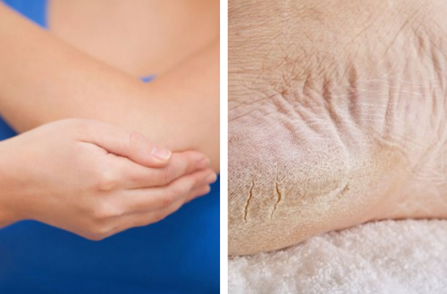 Aprende a suavizar los codos y talones con productos naturales