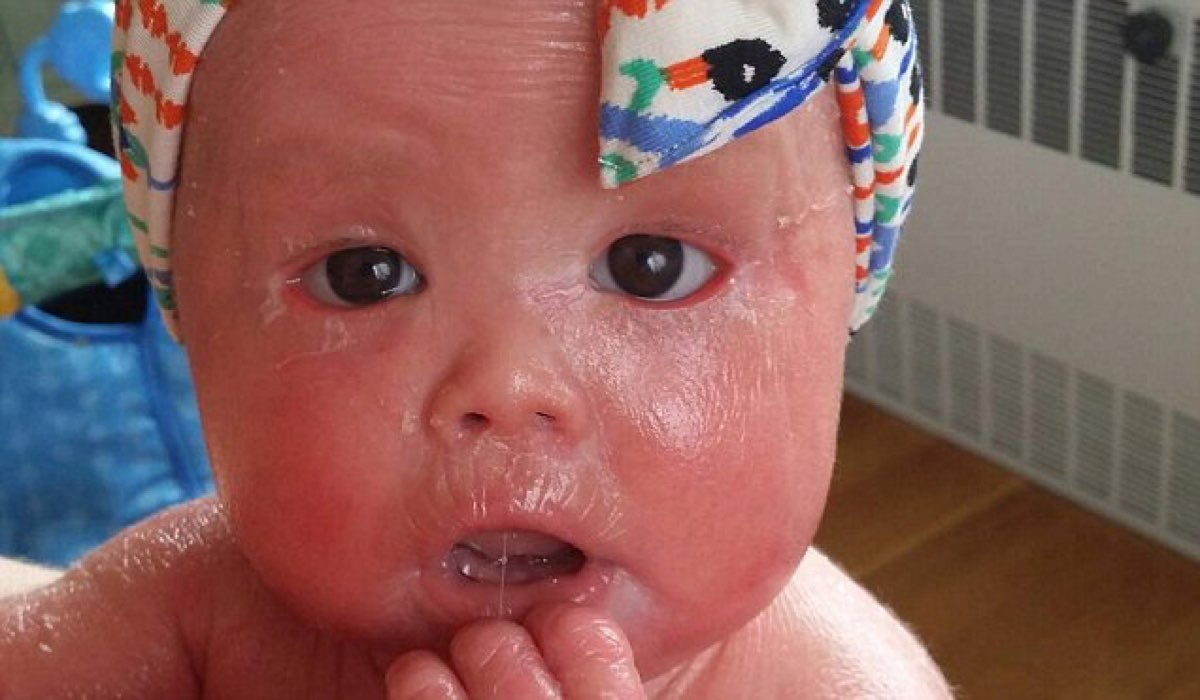 La actual vida de la niña que estremeció al mundo tras nacer sin piel