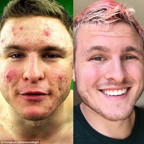 Este joven con un severo caso de acné explica cómo sanó su rostro por ...
