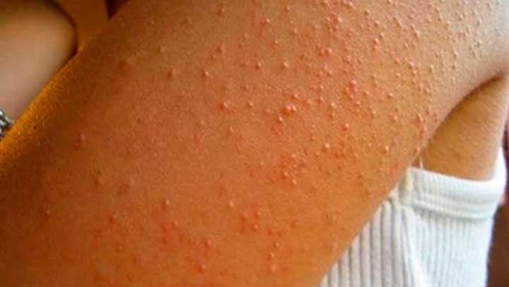 ¡Atención! Estos granitos en los brazos son señal de una posible enfermedad