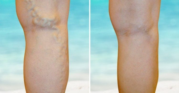 Por qué se forman las venas varicosas en las piernas y cómo tratarlas a ...