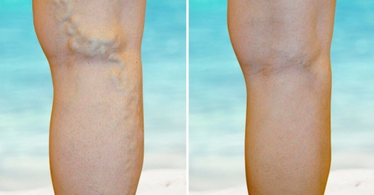 Por Qué Se Forman Las Venas Varicosas En Las Piernas Y Cómo Tratarlas A