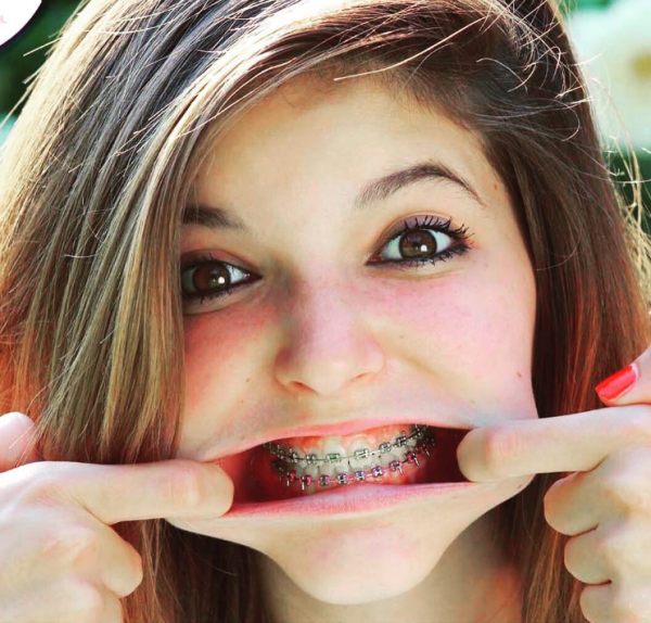 Esta chica sufrió la peor pesadilla que cualquier persona con brackets ...