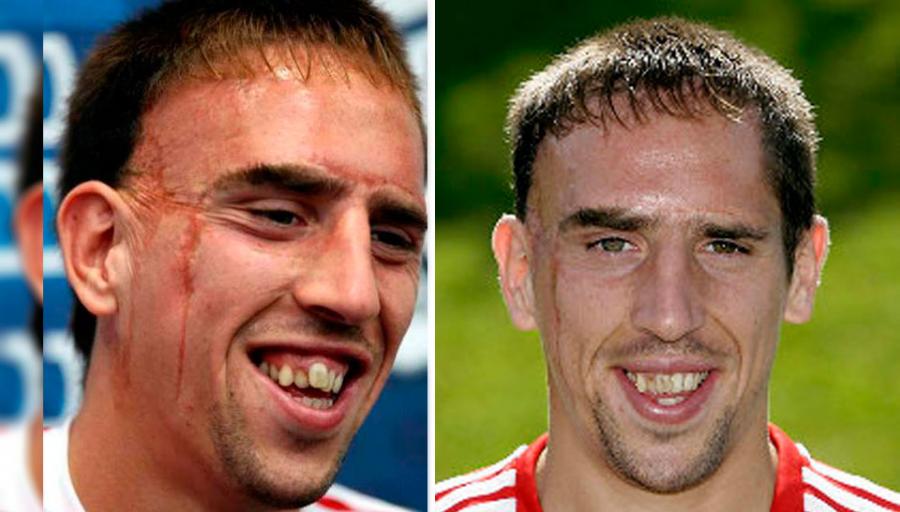 La verdadera historia detrás de la legendaria cicatriz de Frank Ribery ...